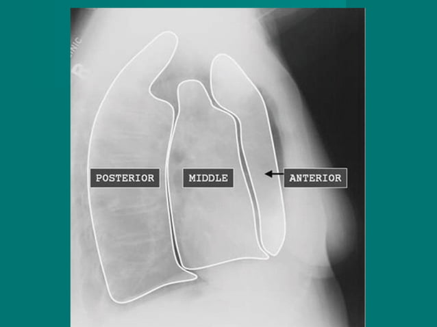 Basics Of CXR interpretation www.radiologydefinition.com