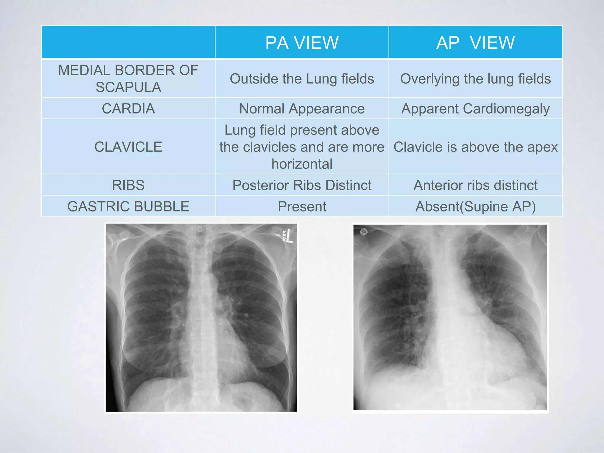 Basics of cxr modified ppt | PPTX