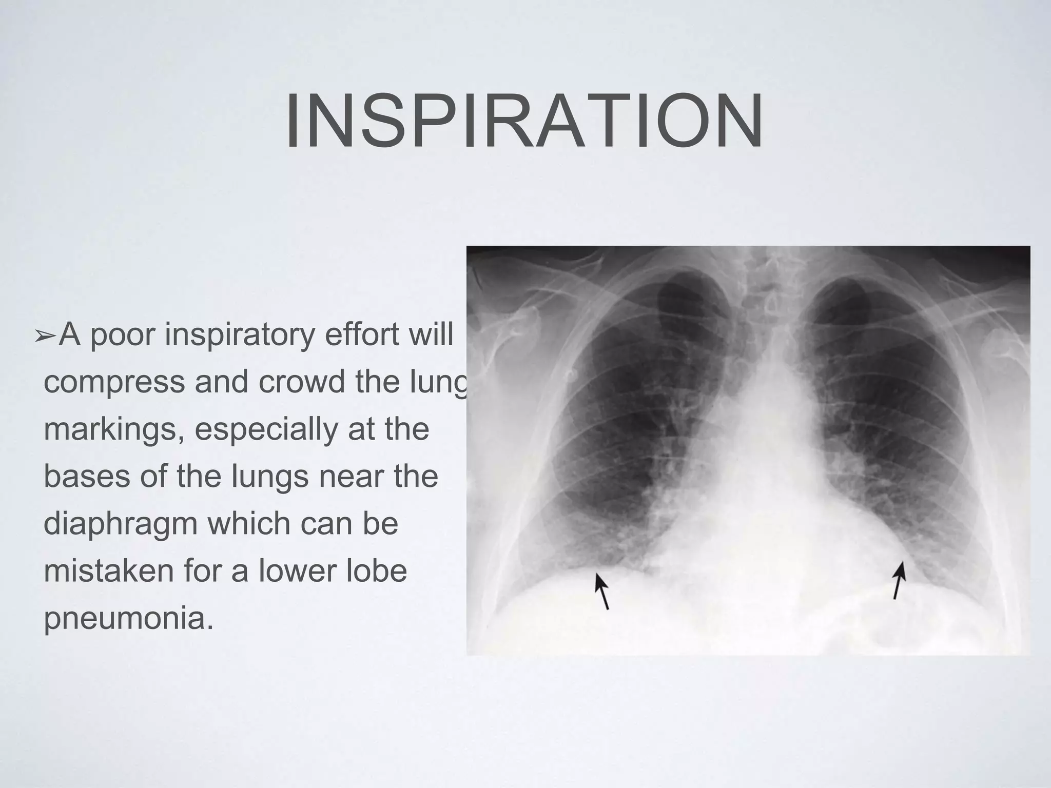 Basics of cxr modified ppt | PPTX