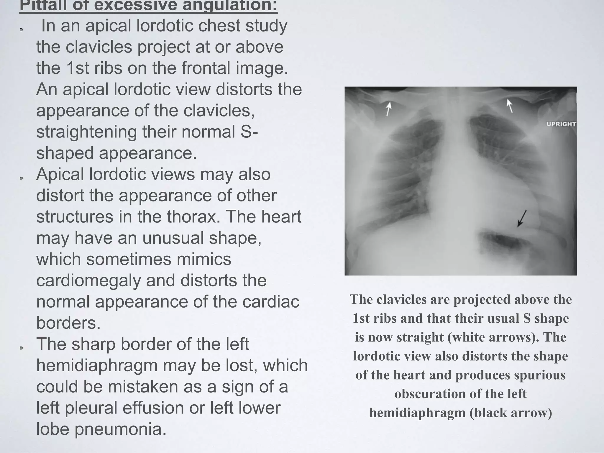 Basics of cxr modified ppt | PPTX
