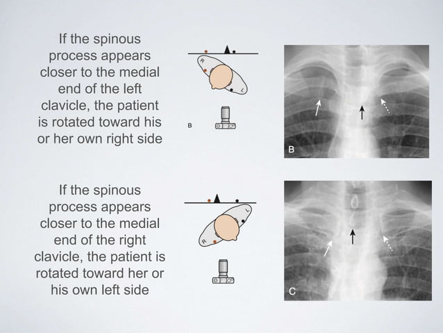 Basics of cxr modified ppt | PPT