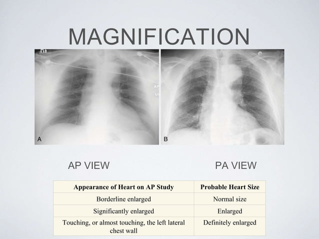 Basics of cxr modified ppt | PPT