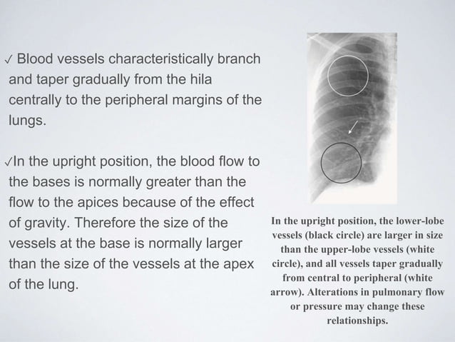 Basics of cxr modified ppt | PPT