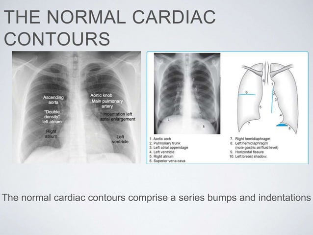 Basics of cxr modified ppt | PPT