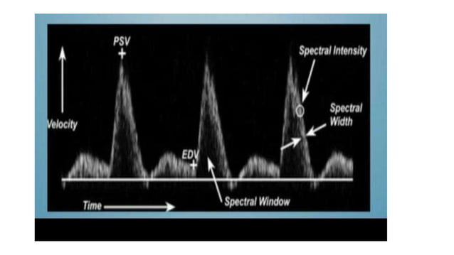 Basics of Doppler Ultrasound .pptx | Heart and Cardiovascular Diseases ...