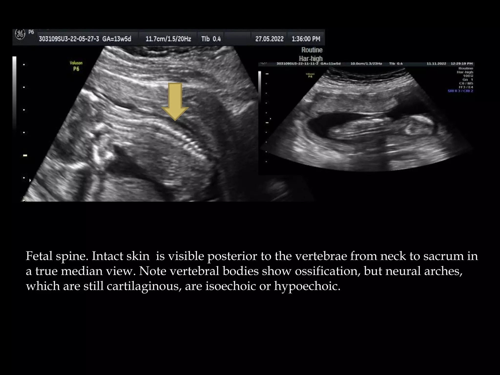 Basics of early pregnancy scan.pptx