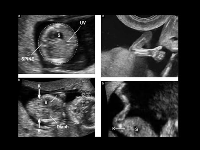 Basics of early pregnancy scan.pptx | Infertility | Reproductive Health