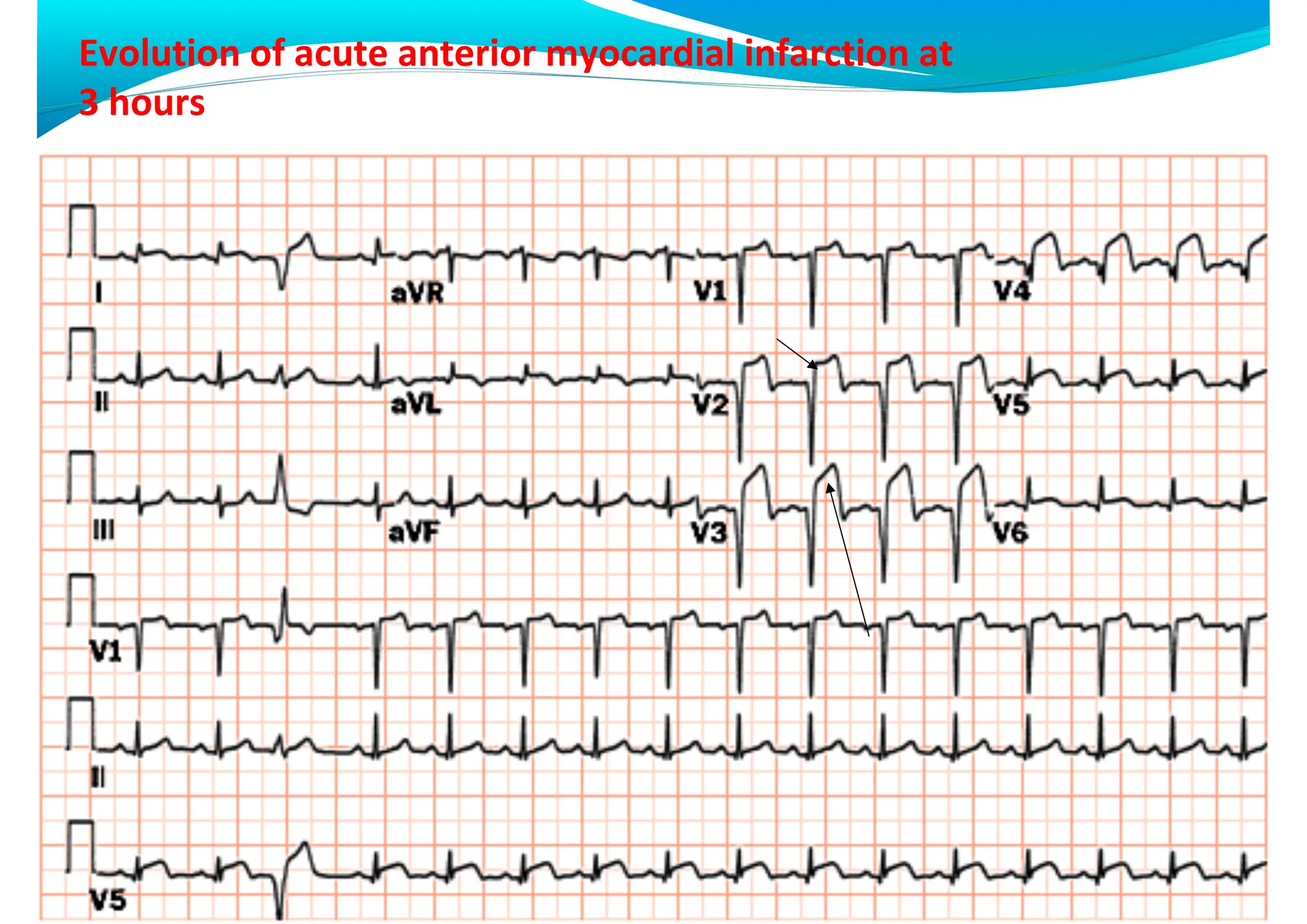 Myocardial infarction and its management | PDF