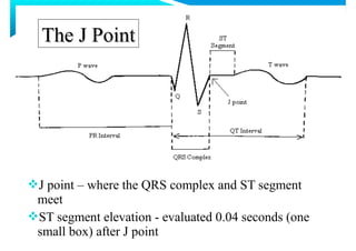 Myocardial infarction and its management | PDF