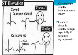 Myocardial infarction and its management | PDF