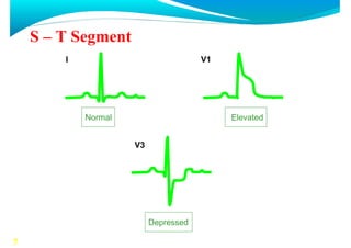 Myocardial infarction and its management | PDF