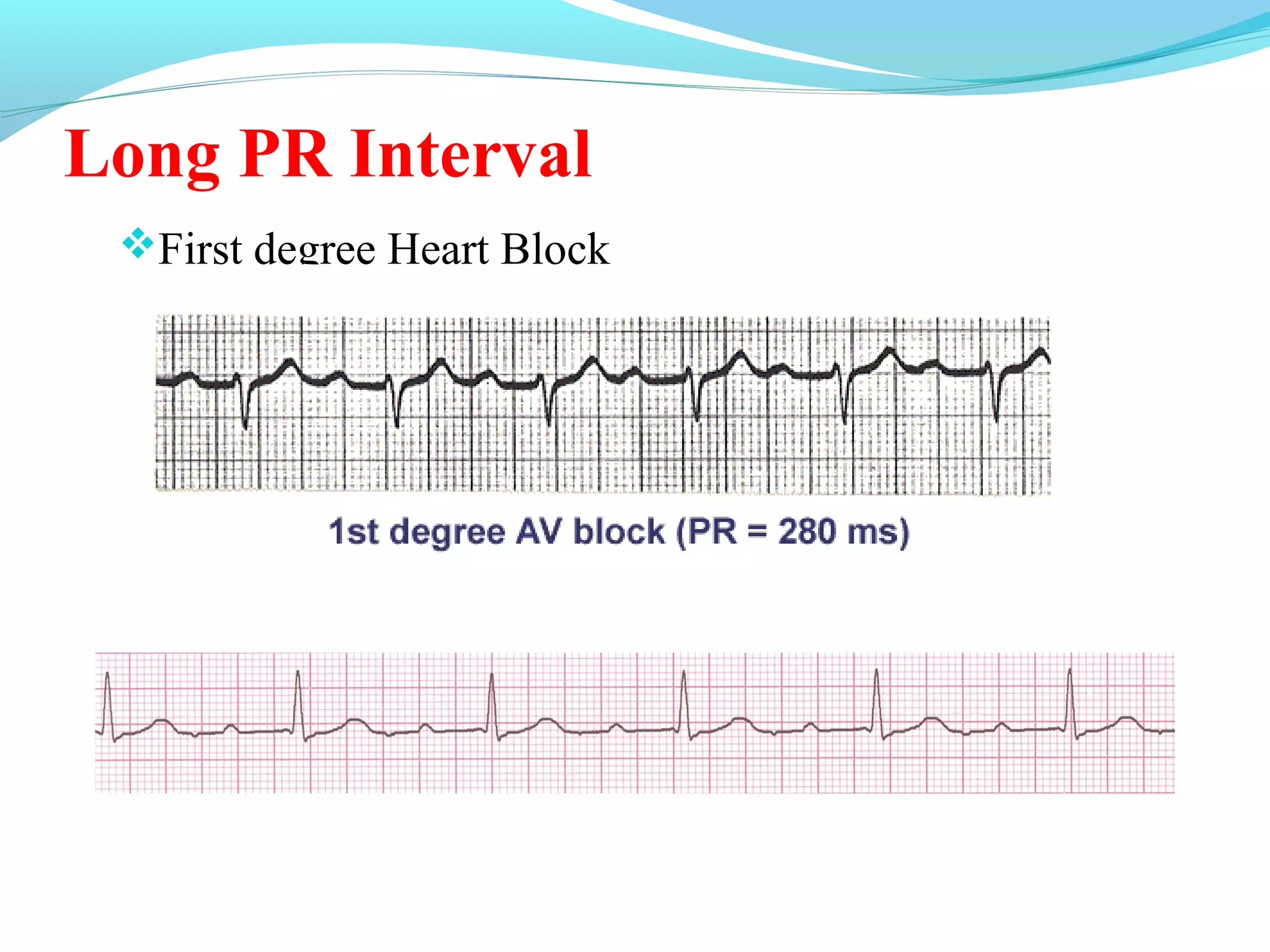 Basics of Electrocardiography(ECG) | PPT