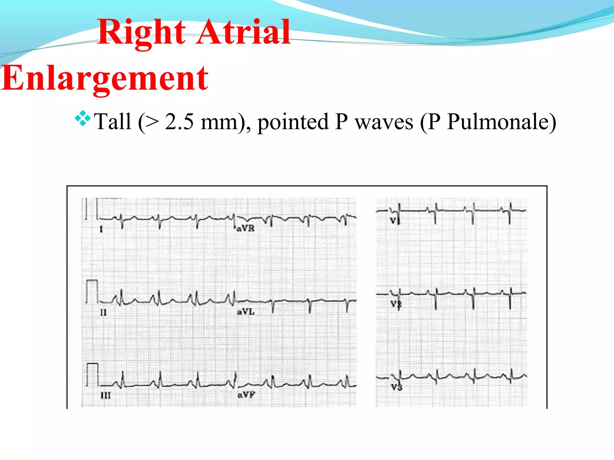 Basics of Electrocardiography(ECG) | PPT