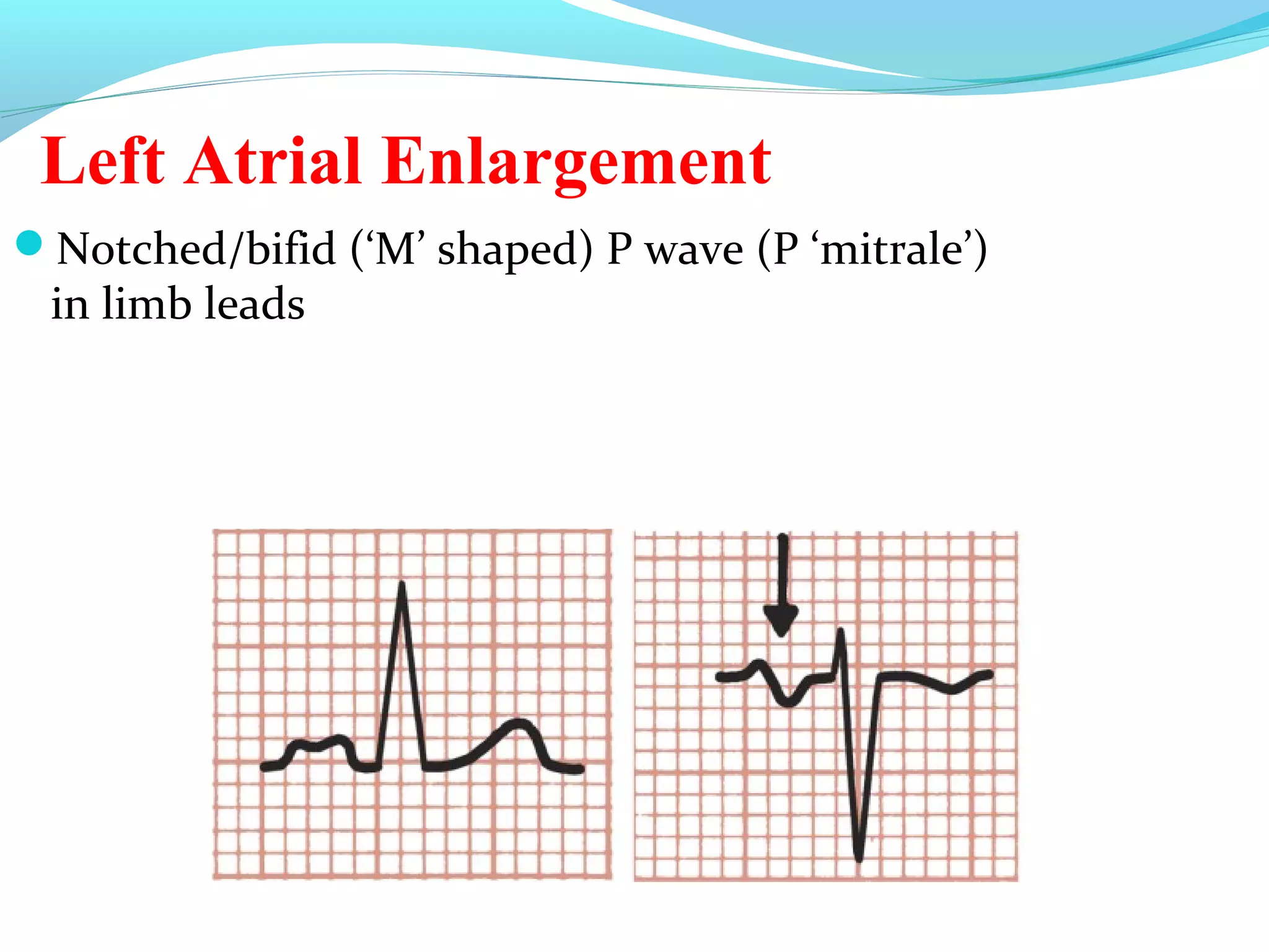 Basics of Electrocardiography(ECG) | PPT