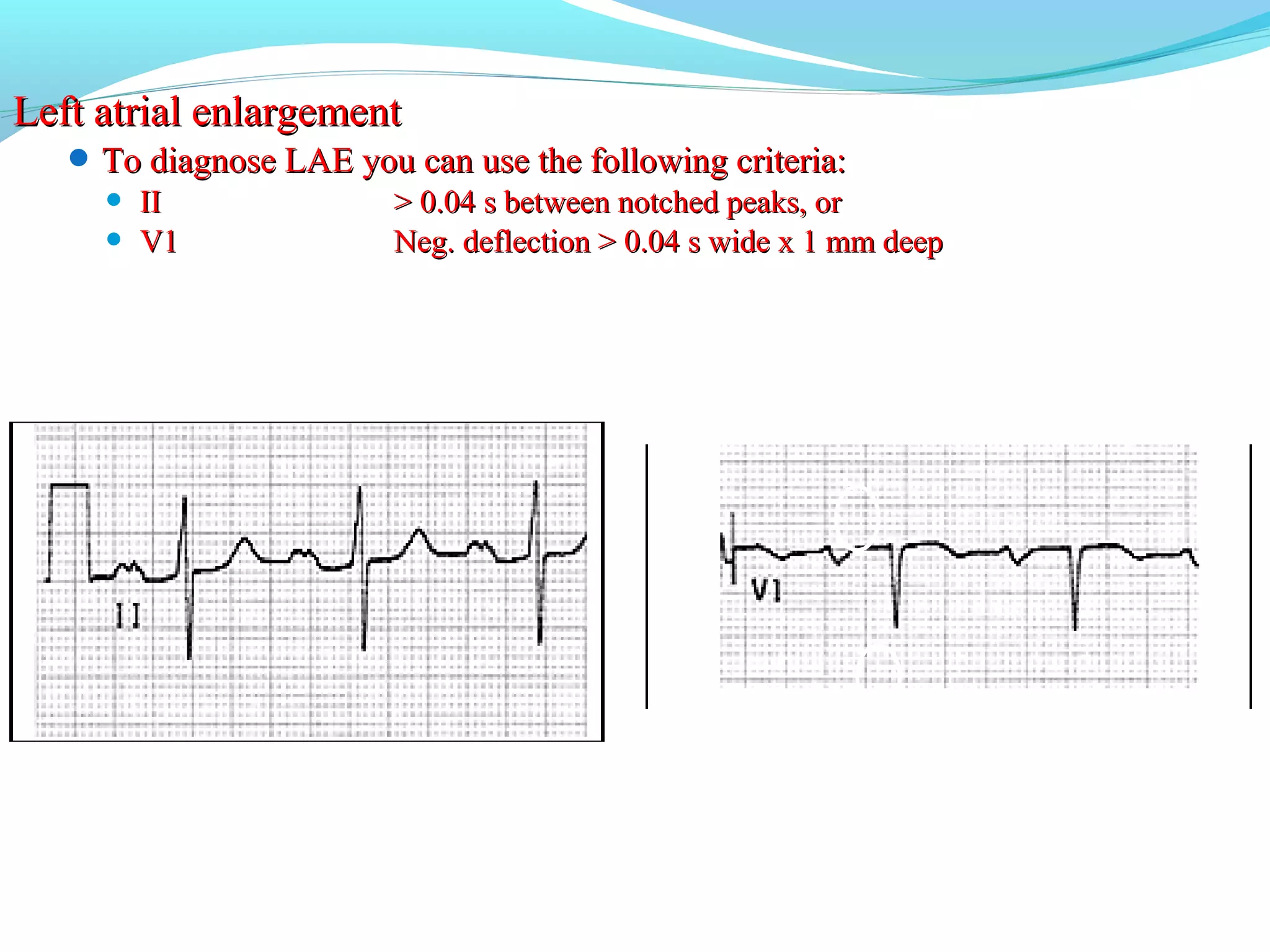 Basics of Electrocardiography(ECG) | PPT