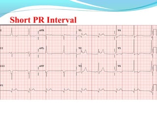 Basics of Electrocardiography(ECG) | PPT