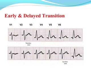 Basics of Electrocardiography(ECG) | PPT