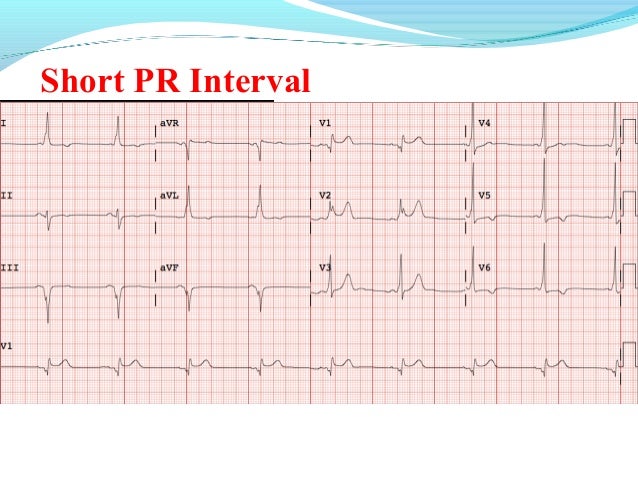 Basics of Electrocardiography(ECG)