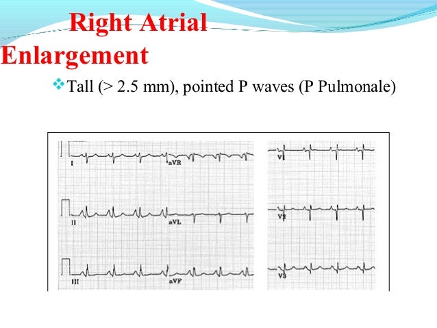 Basics of Electrocardiography(ECG)