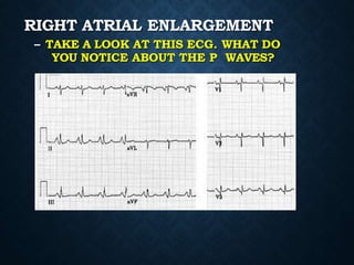 Basics of ecg | PPTX