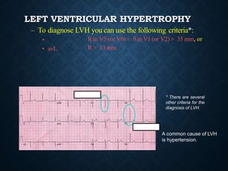 Basics of ecg | PPT