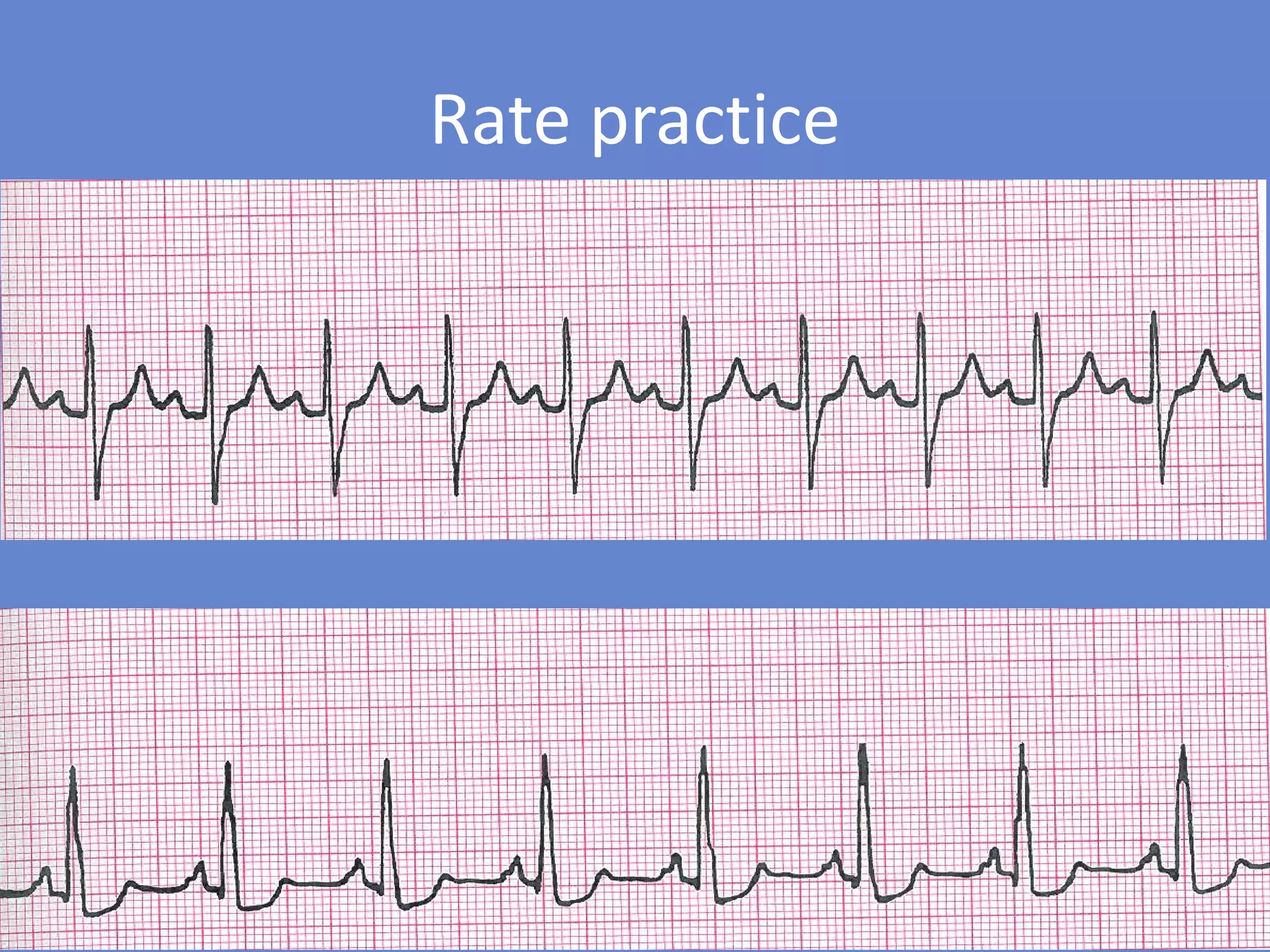 Basics of ecg | PDF