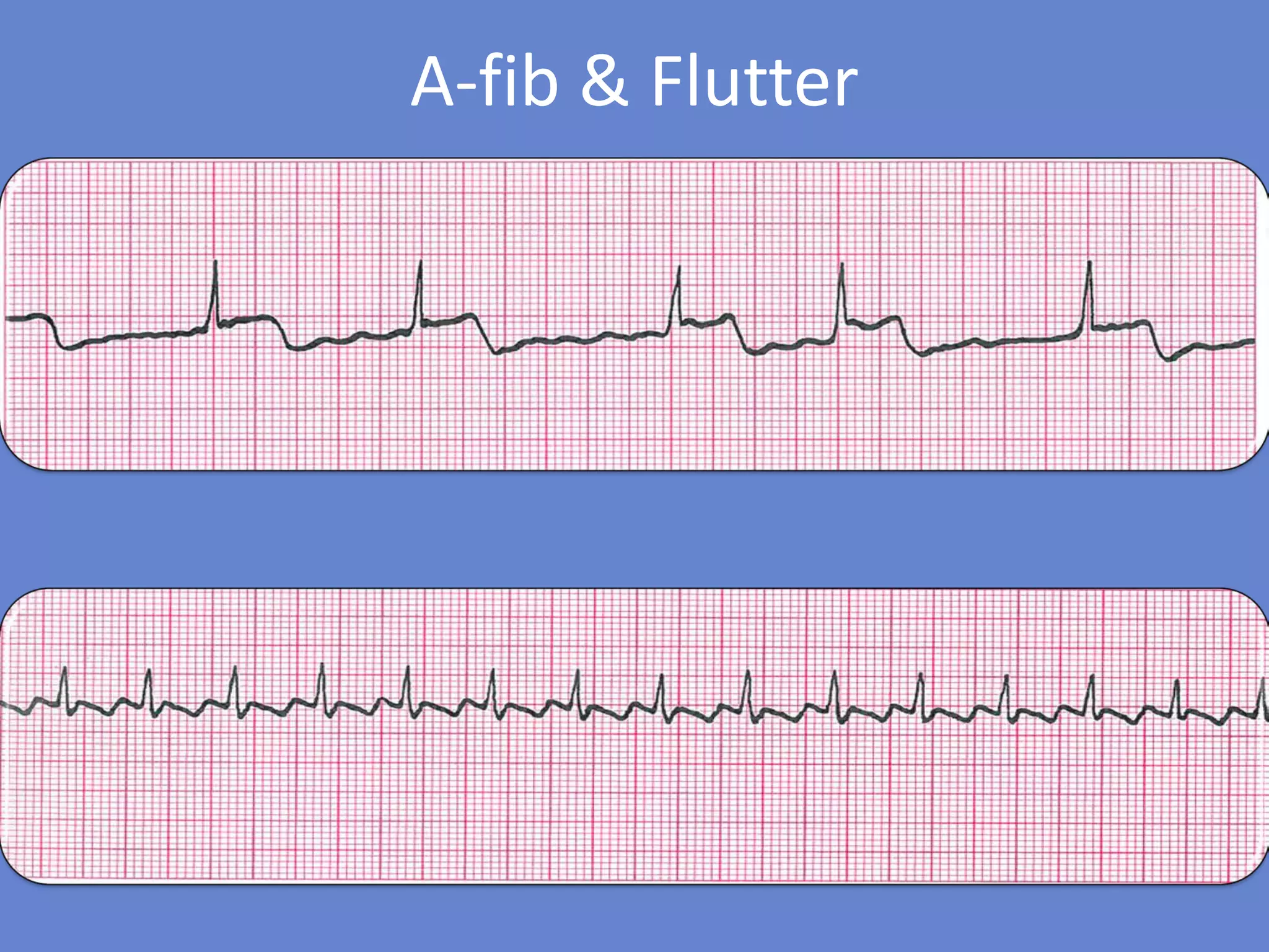 Basics of ecg | PDF