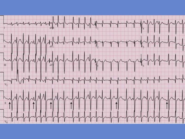 Basics of ecg | PPT