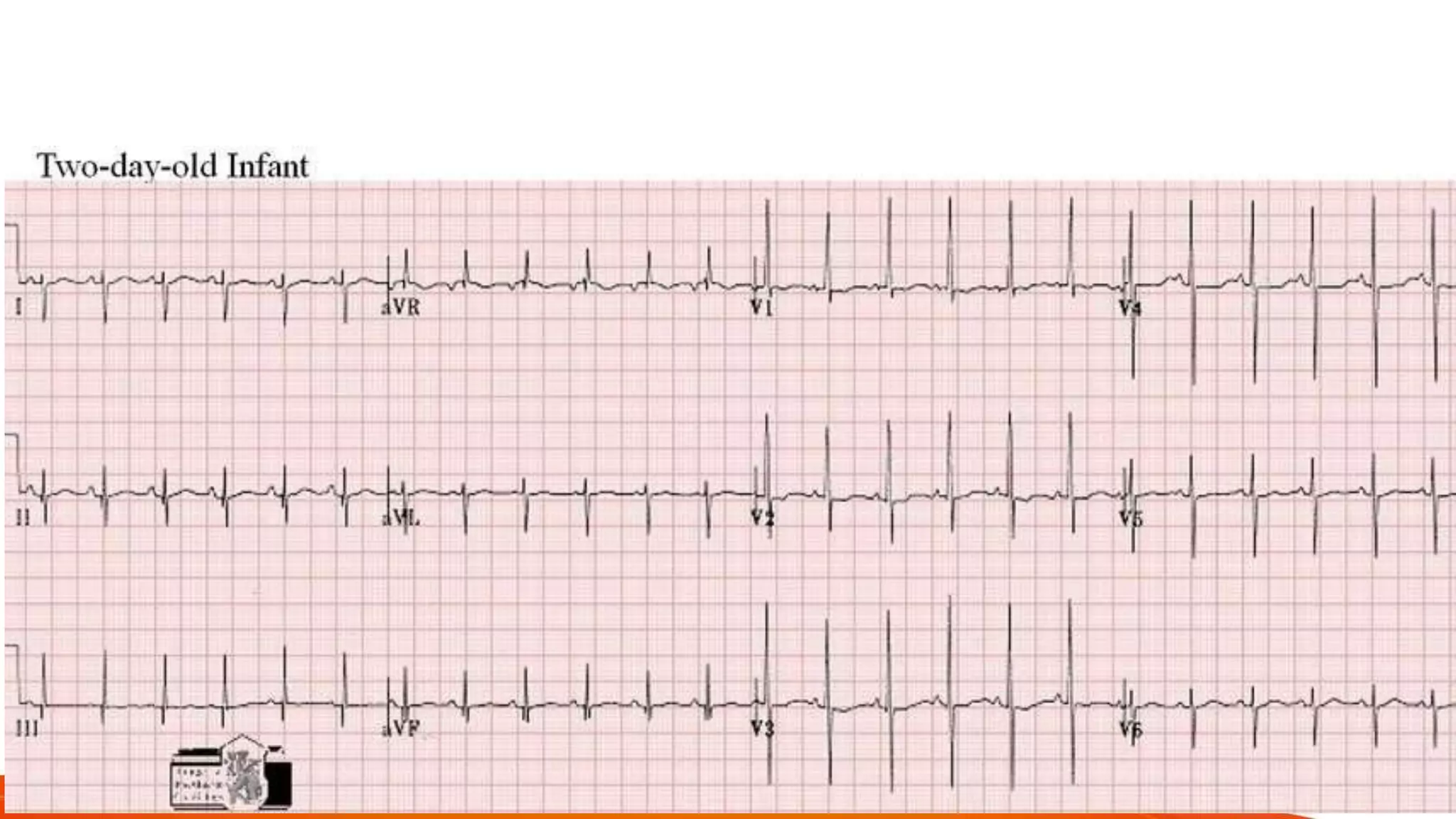 Basics of ecg | PPTX | Heart and Cardiovascular Diseases | Diseases and ...