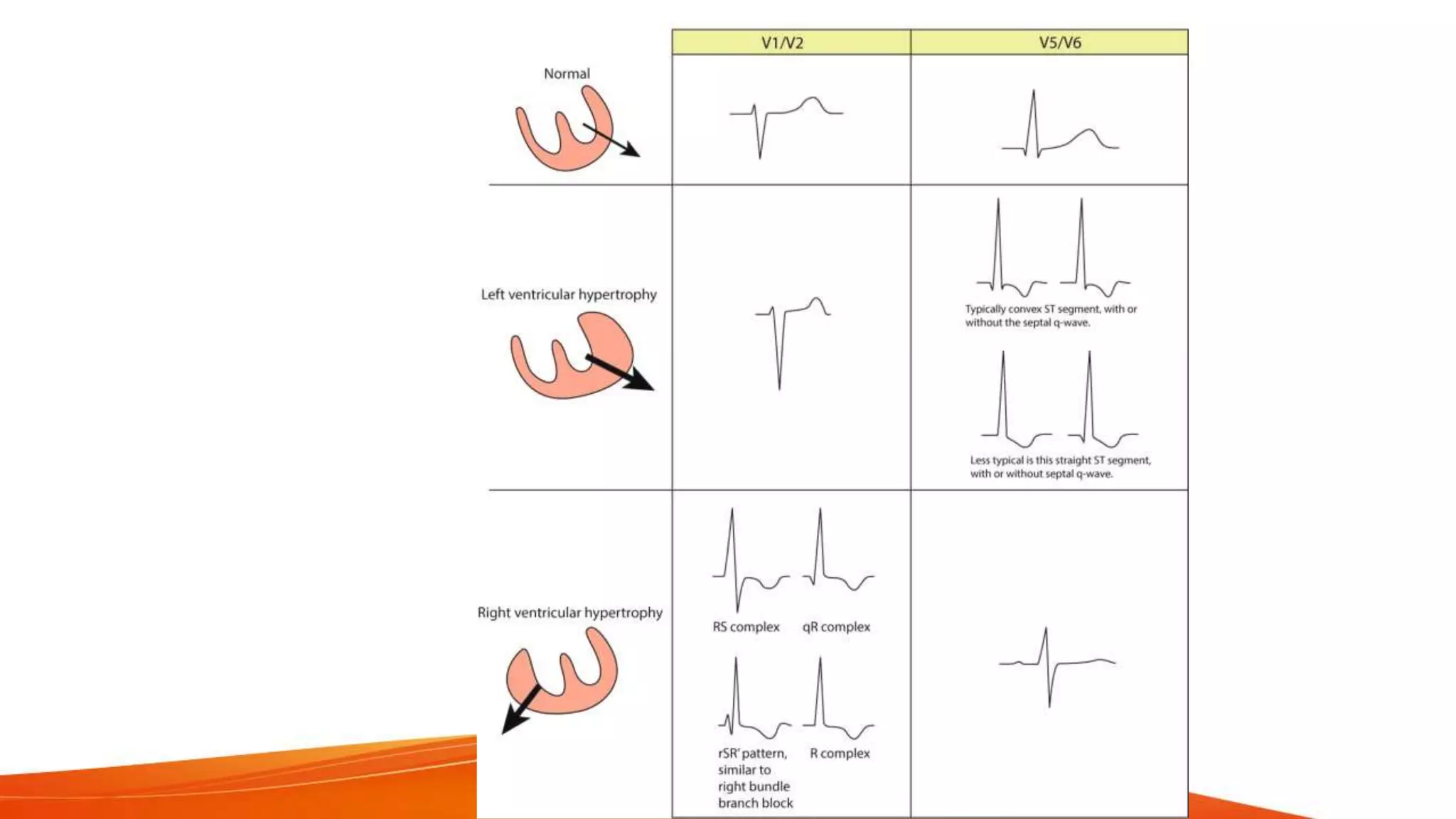 Basics of ecg | PPTX | Heart and Cardiovascular Diseases | Diseases and ...