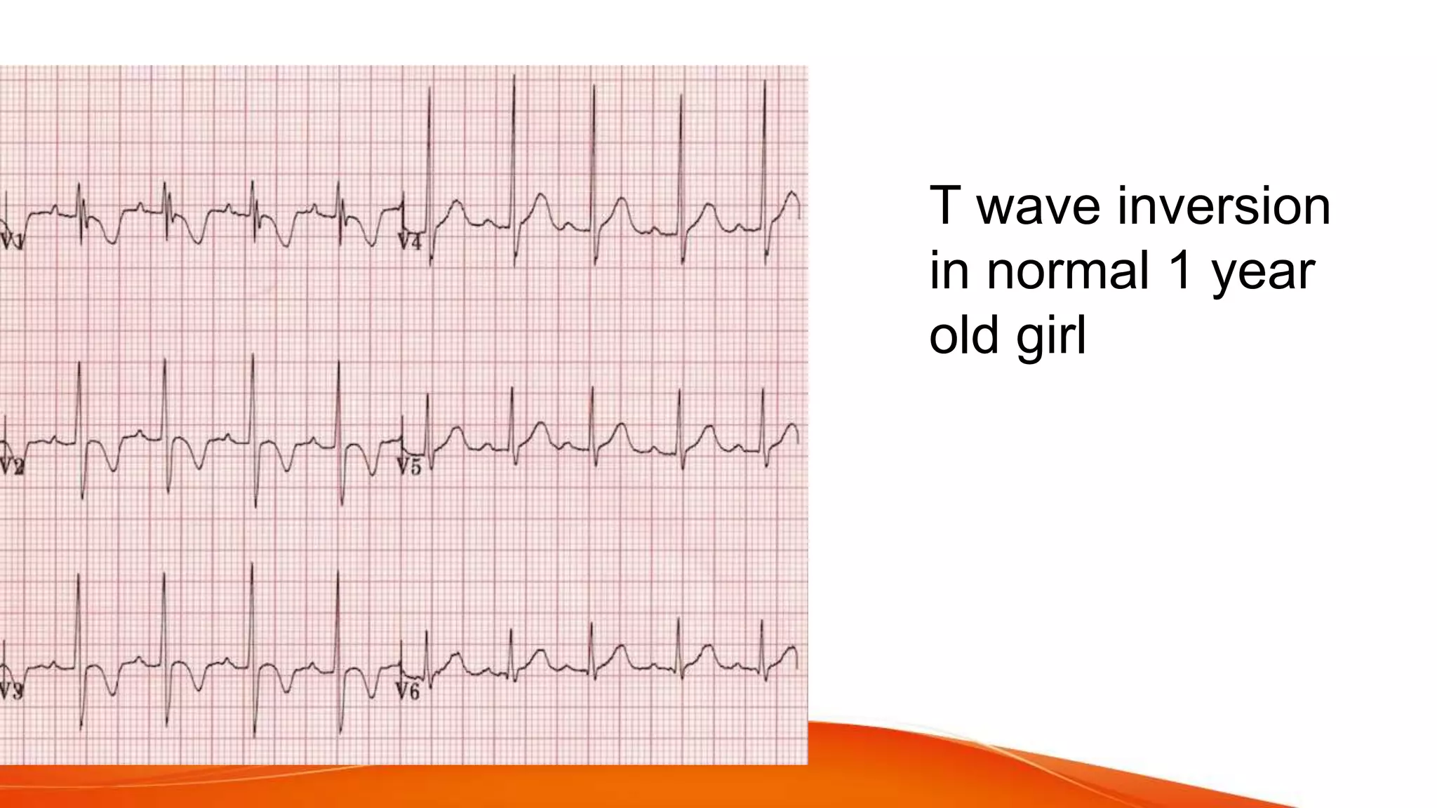 Basics of ecg | PPTX | Heart and Cardiovascular Diseases | Diseases and ...