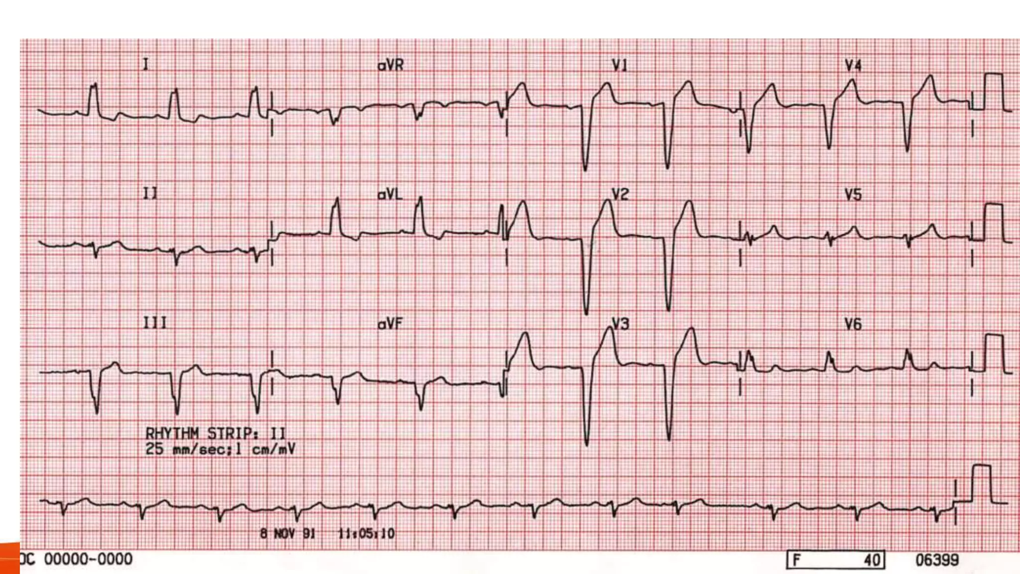 Basics of ecg | PPTX | Heart and Cardiovascular Diseases | Diseases and ...