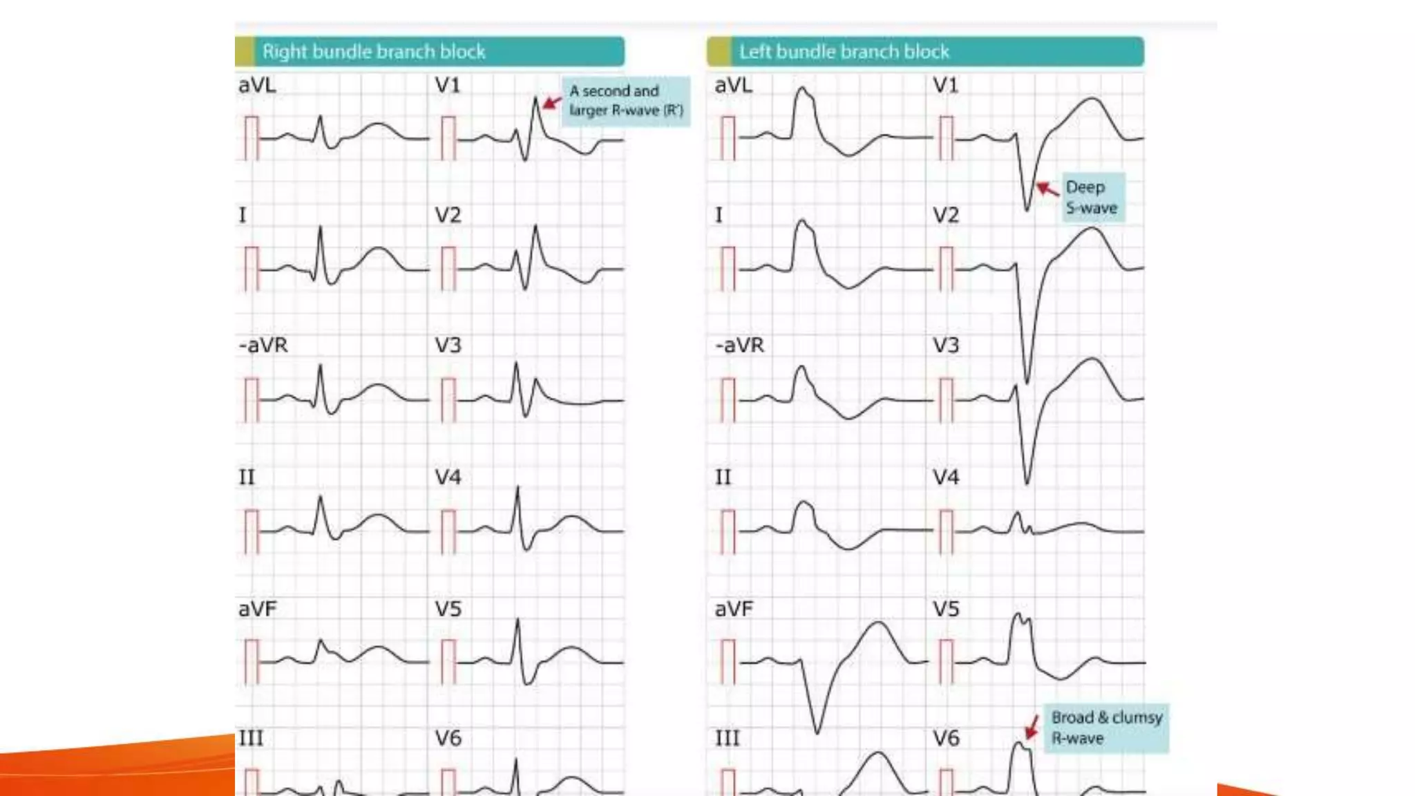 Basics of ecg | PPTX | Heart and Cardiovascular Diseases | Diseases and ...