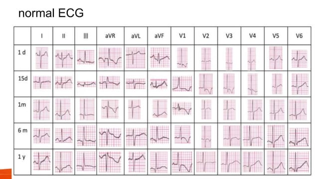 Basics of ecg | PPTX | Heart and Cardiovascular Diseases | Diseases and ...
