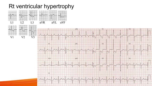 Basics of ecg | PPTX | Heart and Cardiovascular Diseases | Diseases and ...