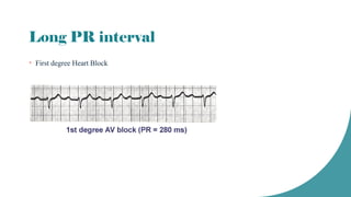 BASICS OF ECGBASICS OF ECGBASICS OF ECGBASICS OF ECG | PPT