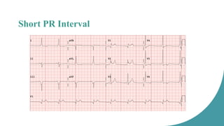 BASICS OF ECGBASICS OF ECGBASICS OF ECGBASICS OF ECG | PPTX