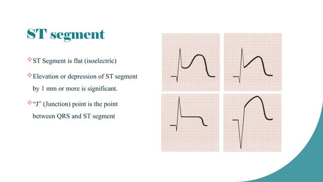 BASICS OF ECGBASICS OF ECGBASICS OF ECGBASICS OF ECG | PPT