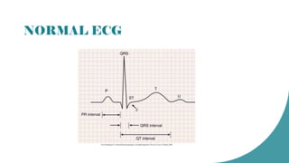 BASICS OF ECGBASICS OF ECGBASICS OF ECGBASICS OF ECG | PPTX