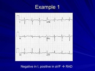 Basics of ECG.ppt dr.k.subramanyam | PPT