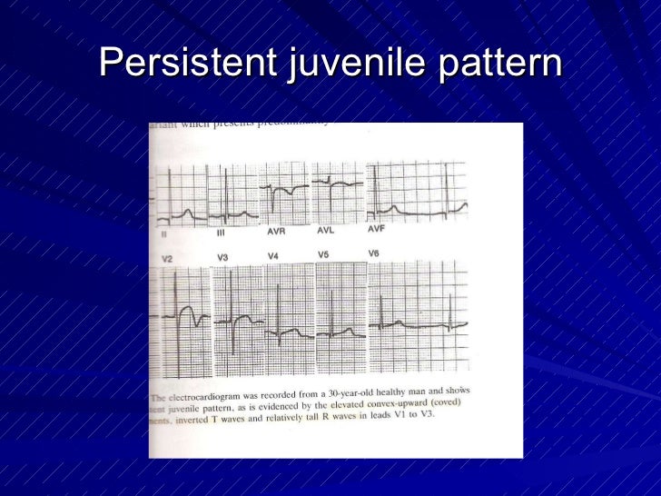 Basics of ECG.ppt dr.k.subramanyam