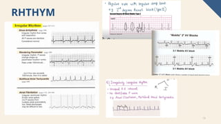 Basics of Electro Cardio Gram Interpretation.pptx