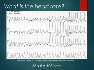 Basics of ecg interpretation by dr sai | PPT