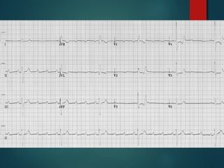 Basics of ecg interpretation by dr sai | PPT