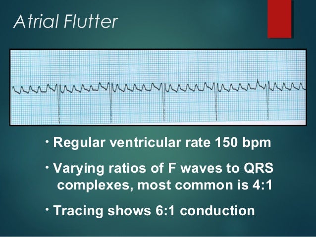 Basics of ecg interpretation by dr sai