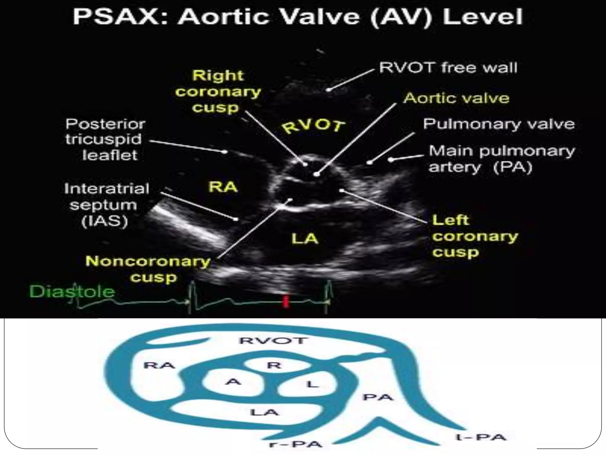 Basics of echo Cardiac Structure, Chamber quantifications & Artifacts.pptx