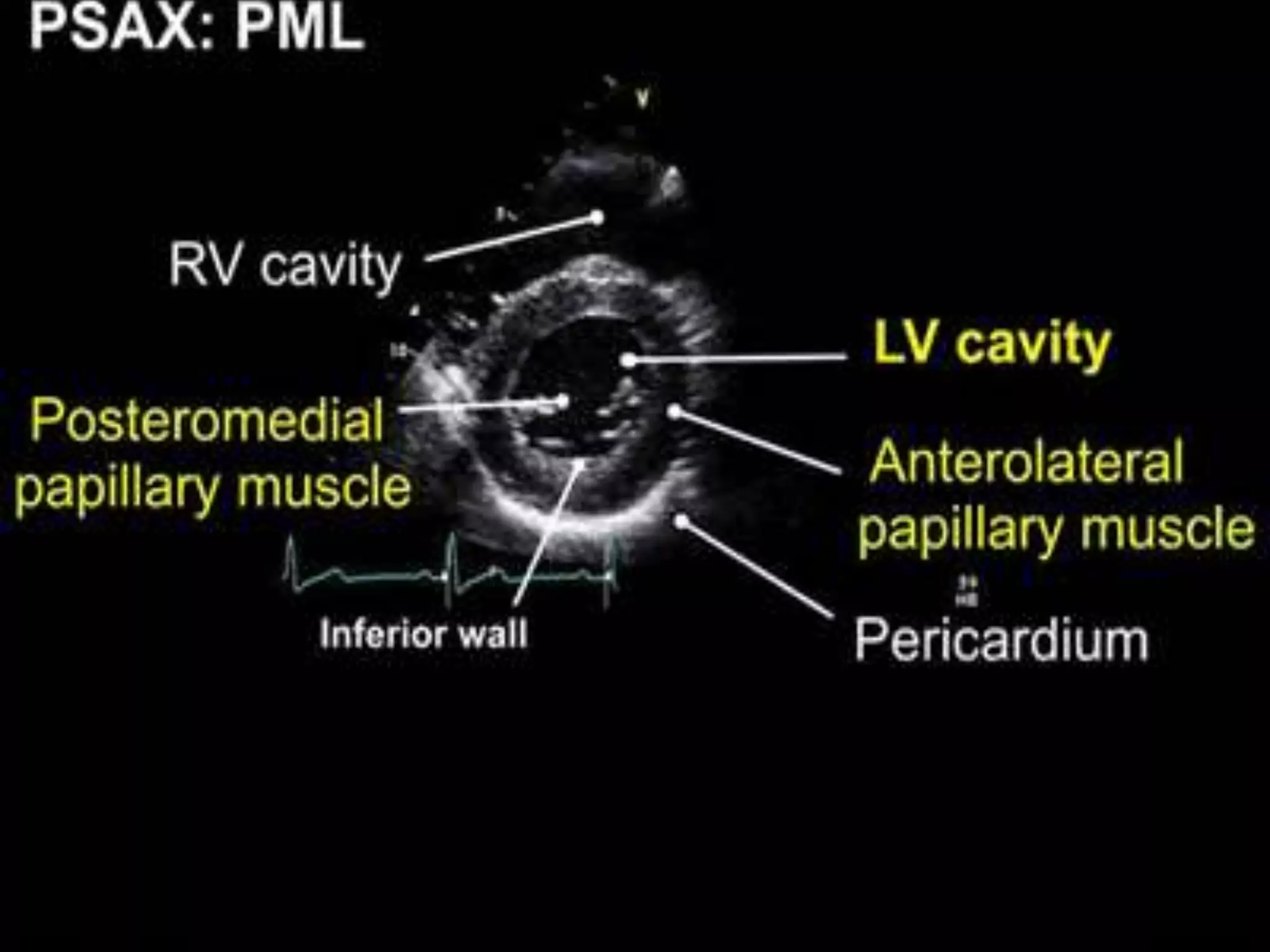 Basics of echo Cardiac Structure, Chamber quantifications & Artifacts.pptx