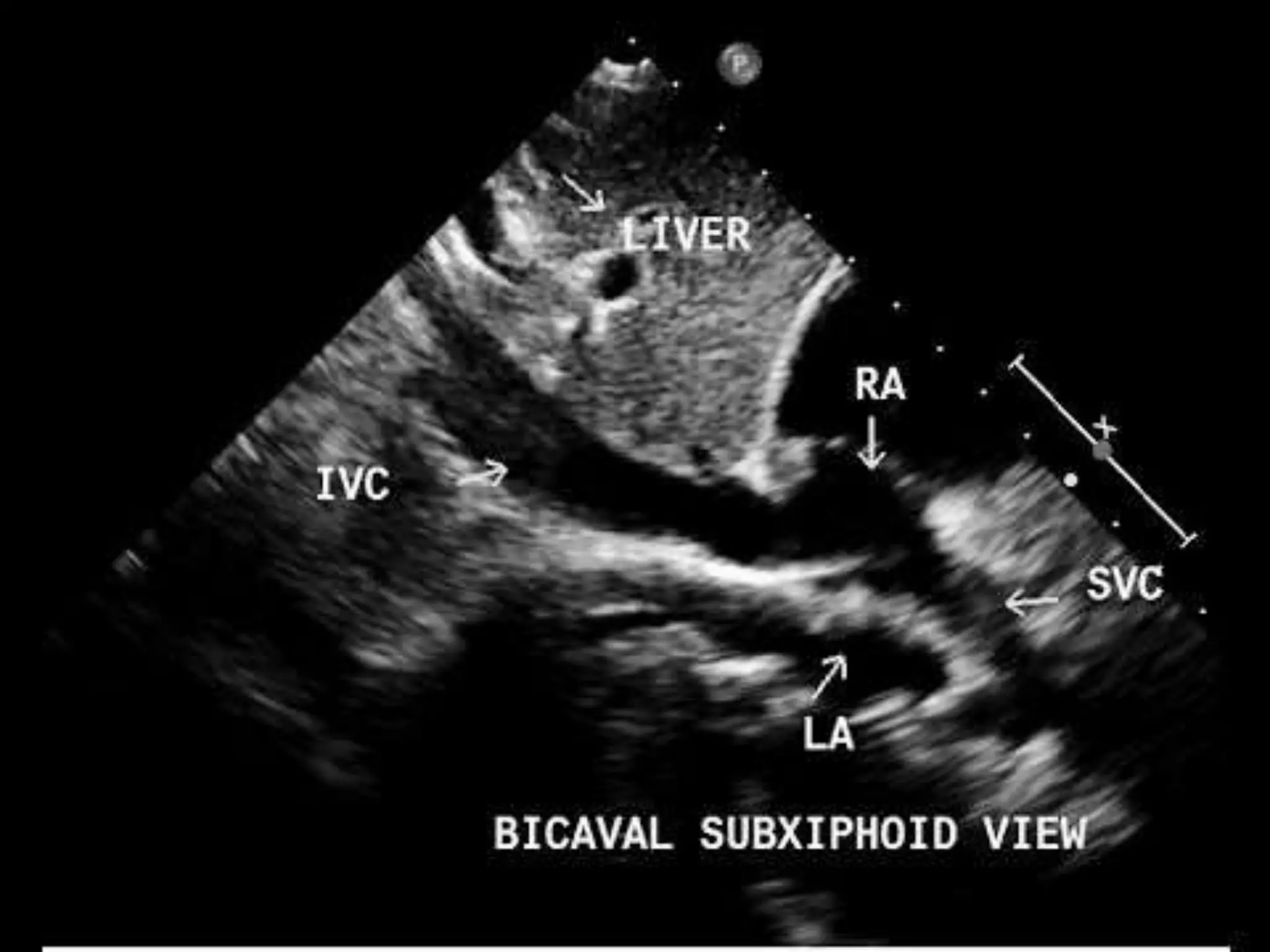 Basics of echo Cardiac Structure, Chamber quantifications & Artifacts.pptx