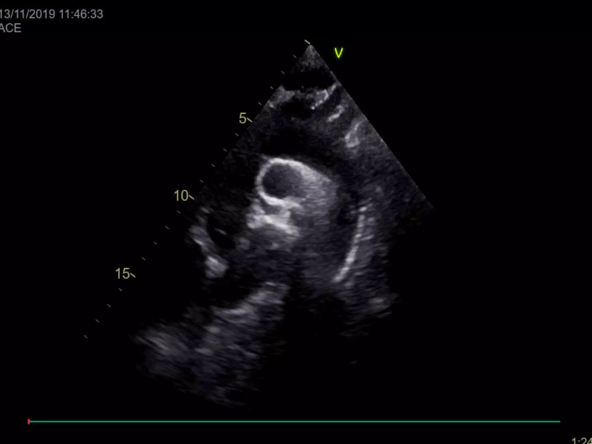 Basics of echo Cardiac Structure, Chamber quantifications & Artifacts.pptx