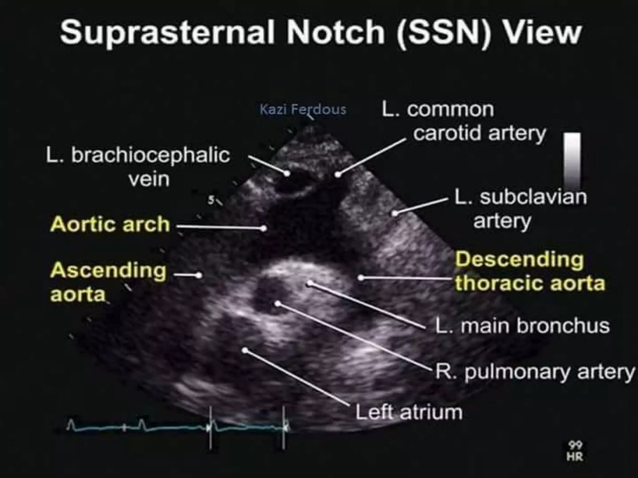 Basics of echo Cardiac Structure, Chamber quantifications & Artifacts.pptx